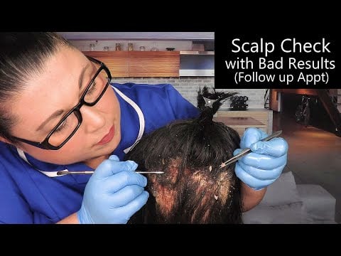 ASMR Scalp Check with Bad Results (Dry Skin Removal, Dandruff Removal ...